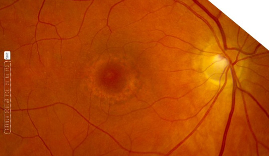 Manifestaciones en retina por deficiencia de 3-hidroxiacil-coa ... Manifestaciones en retina por deficiencia de 3-hidroxiacil-coa ...