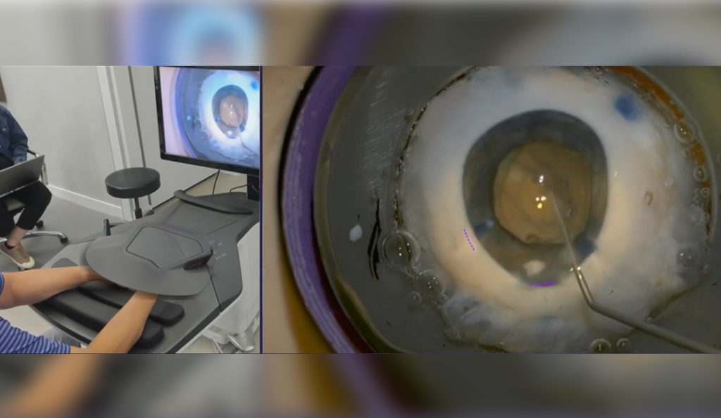 Cirugía robótica de cataratas con la plataforma ORYOM - Franja Ocular