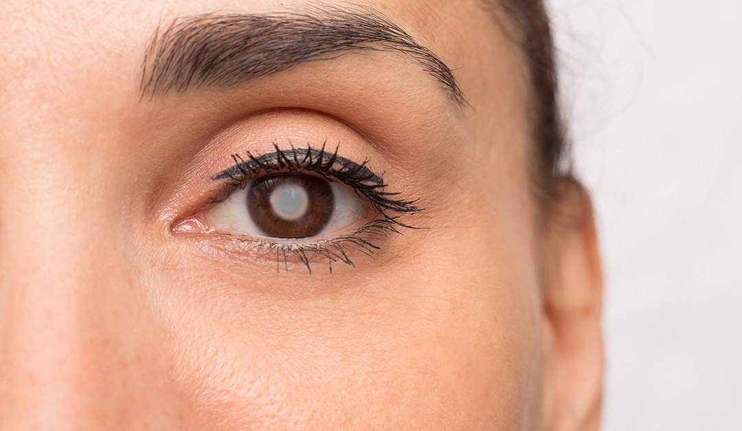 Manejo Integral del Paciente con Catarata y Glaucoma - Franja Ocular