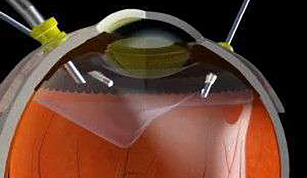 Complejidades del manejo de la catarata tras vitrectomía pars plana ...